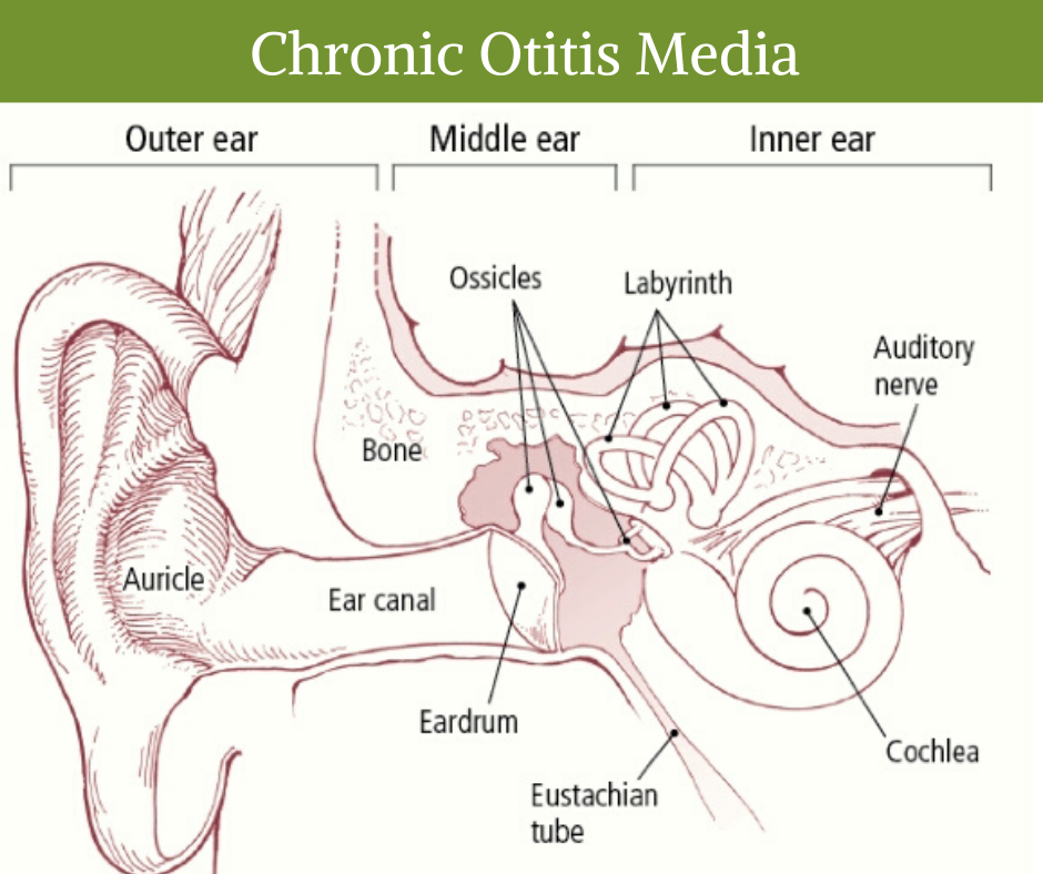 Chronic Otitis Media Treatment in Delhi - Surgery & Cost | Adventis