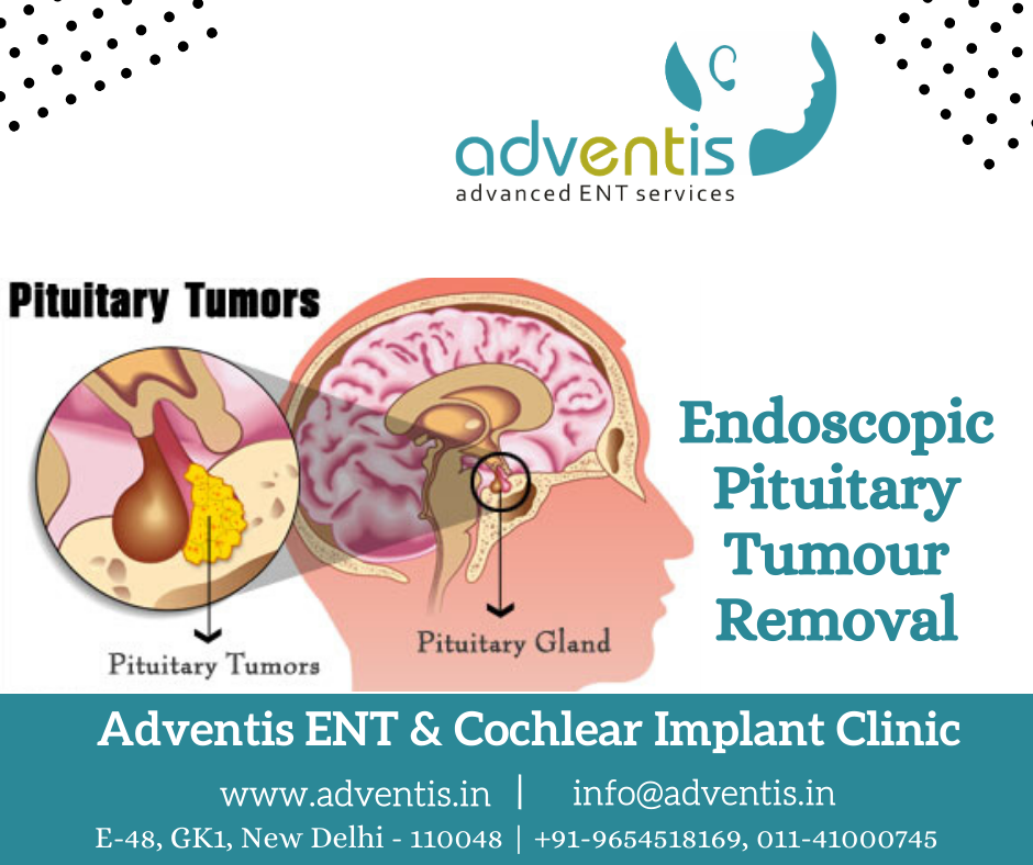 Endoscopic Pituitary Surgery & Tumour Removal | Adventis