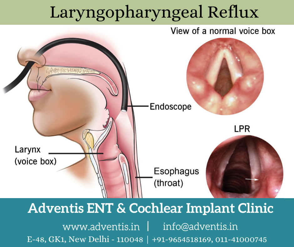 Laryngopharynx Reflux