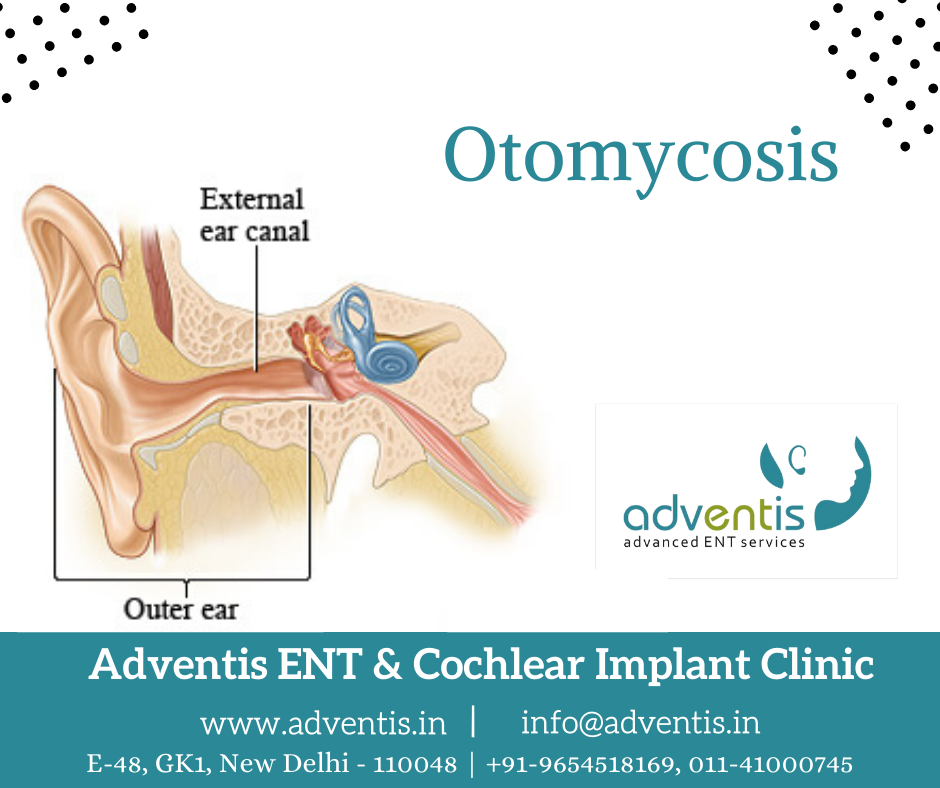 Best Otomycosis Treatment in Delhi - Doctor & Cost | Adventis