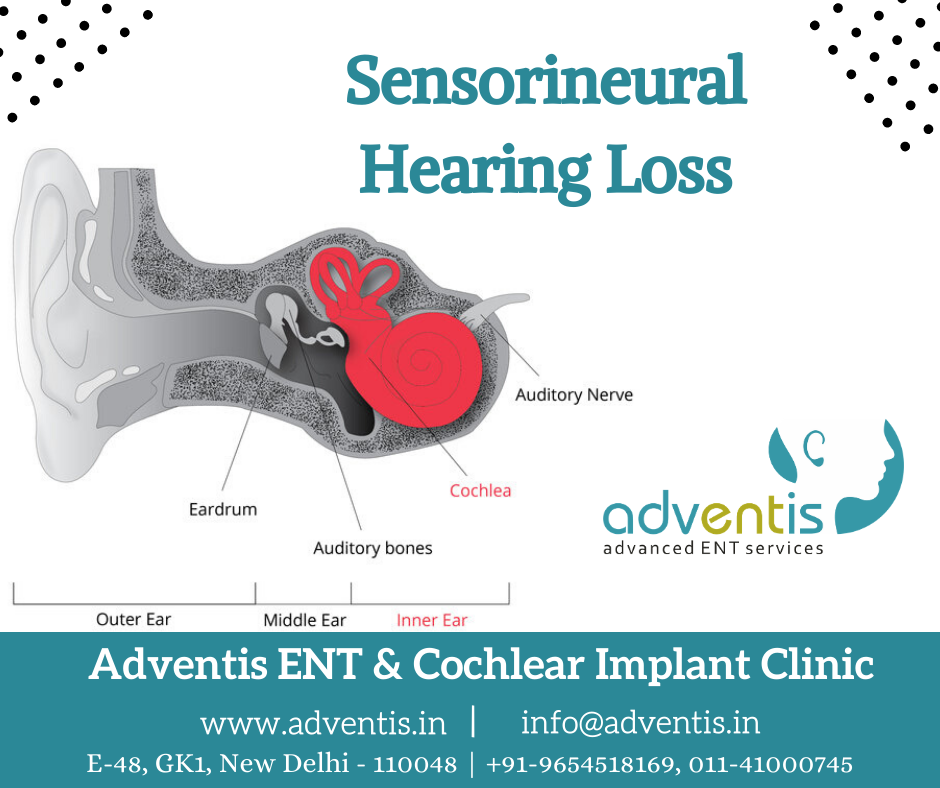 Sensorineural Hearing Loss Types Of Hearing Loss | Audiologist Happy
