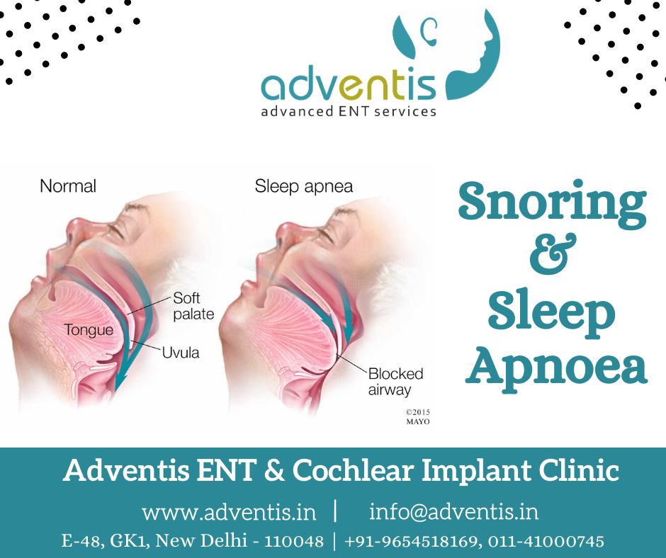 Snoring Treatment, Sleep Apnoea Treatment & Surgery in Delhi | Adventis