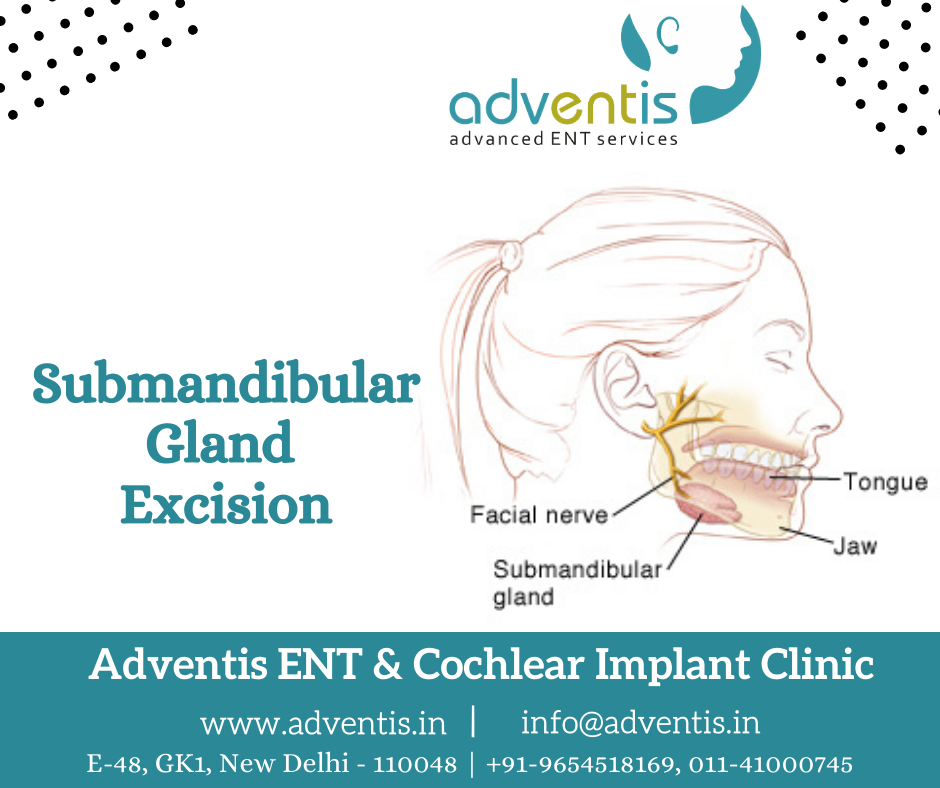 Submandibular Duct SALIVARY GLAND SURGERY Dr John Chaplin Head And