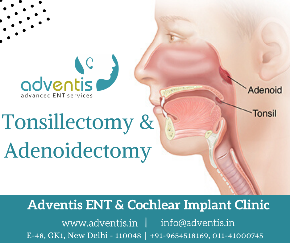 Tonsillectomy And Adenoidectomy