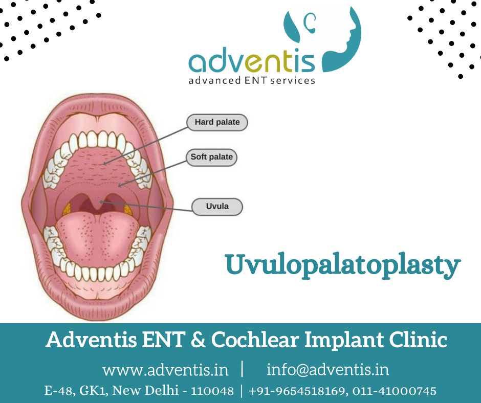 Top ENT Clinic For Uvulopalatoplasty in India | Adventis