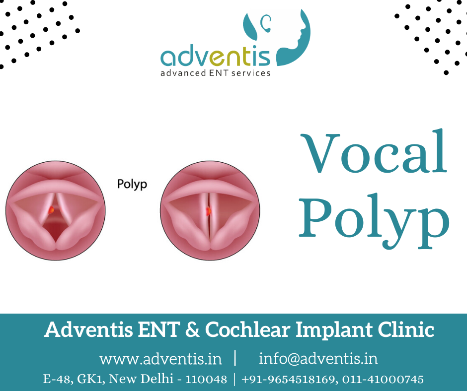 Vocal Cord Polyp Surgery & Treatment in Delhi| Adventis