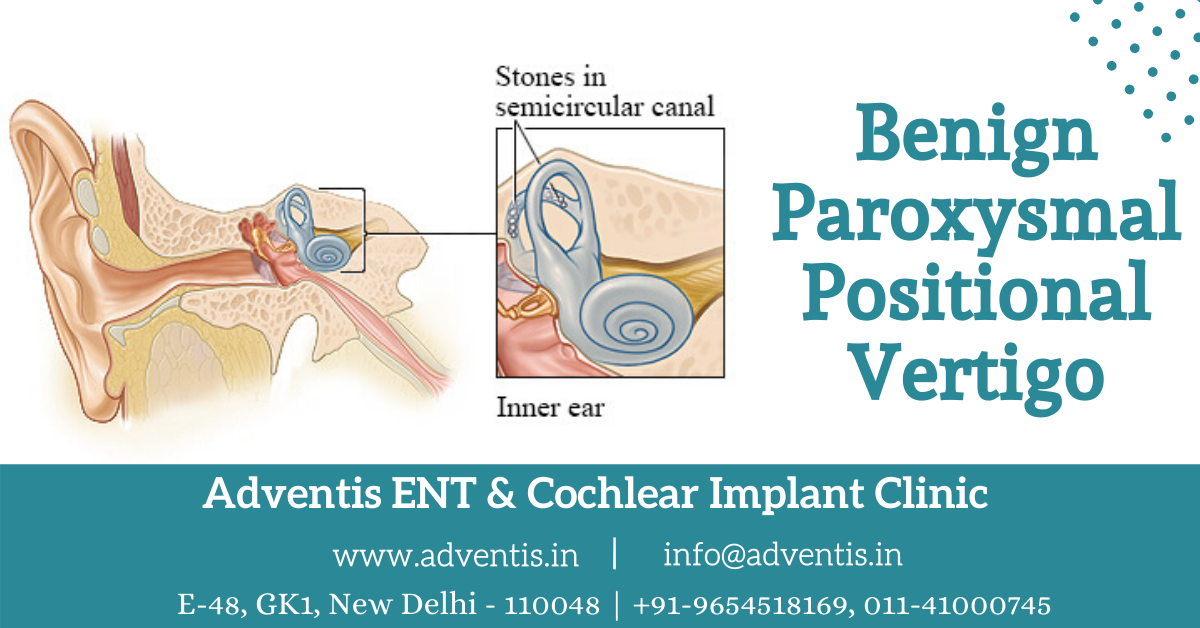 Benign Paroxysmal Positional Vertigo (BPPV) Treatment in Delhi | Adventis