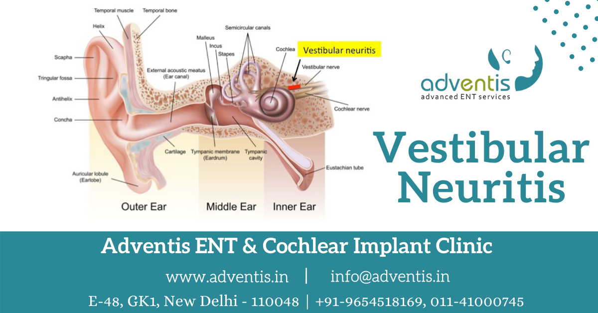 Best Vestibular Neuritis Doctor in Delhi - Treatment & Cost | Adventis