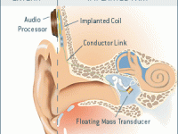 Vibrant Soundbridge Middle Ear Implant Surgery & Treatment in Delhi ...