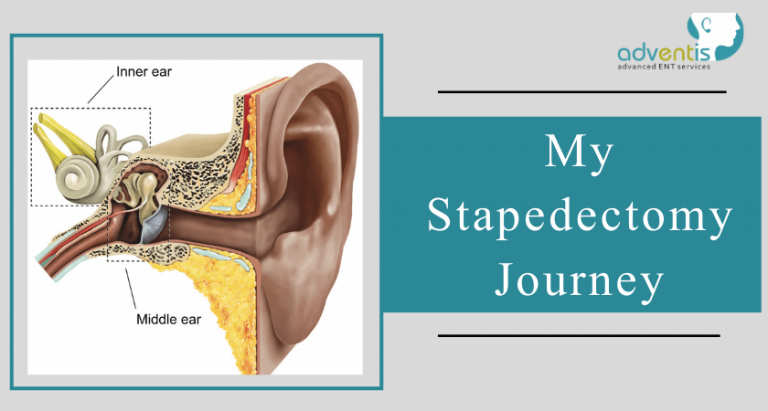 Stapedectomy Surgery, Stapedectomy Recovery & Cost in India | Adventis ENT