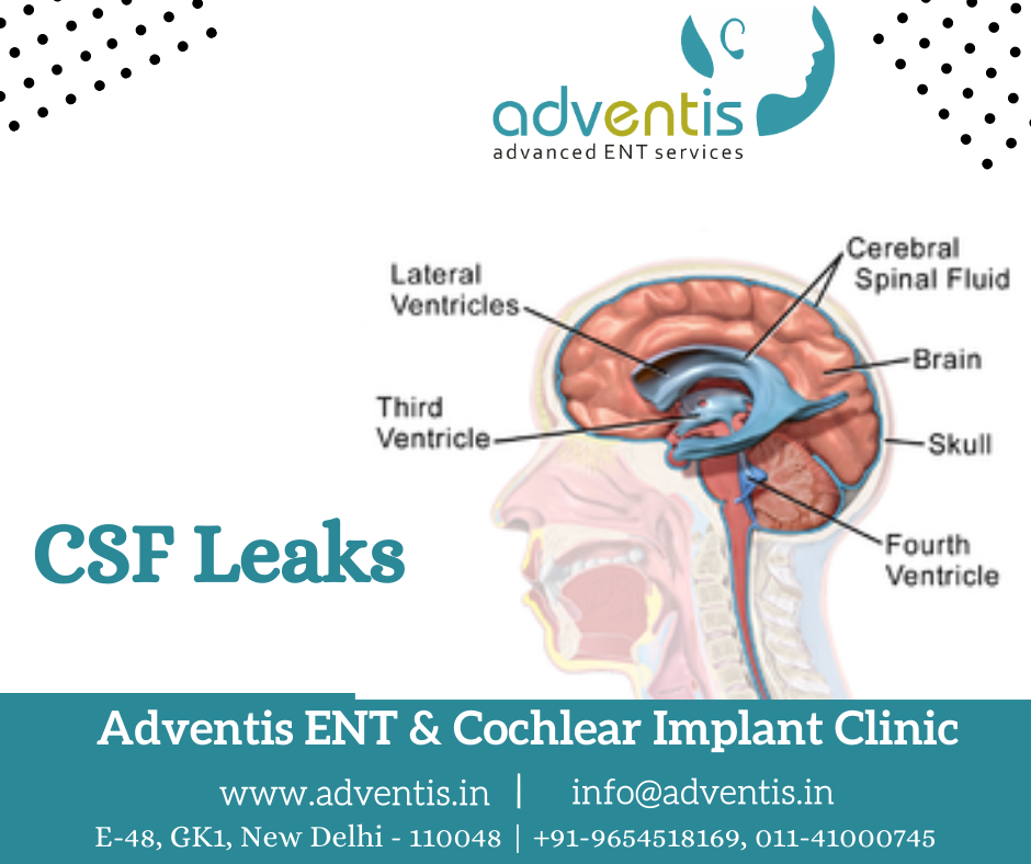 CSF Leaks - Cerebrospinal Fluid Leak Surgery & Treatment in Delhi | Adventis