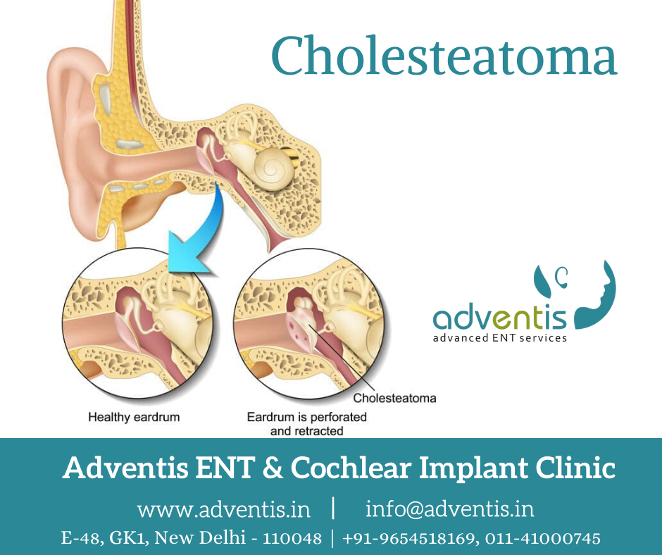 Best Cholesteatoma ENT Surgeon in Delhi - Treatment & Cost | Adventis