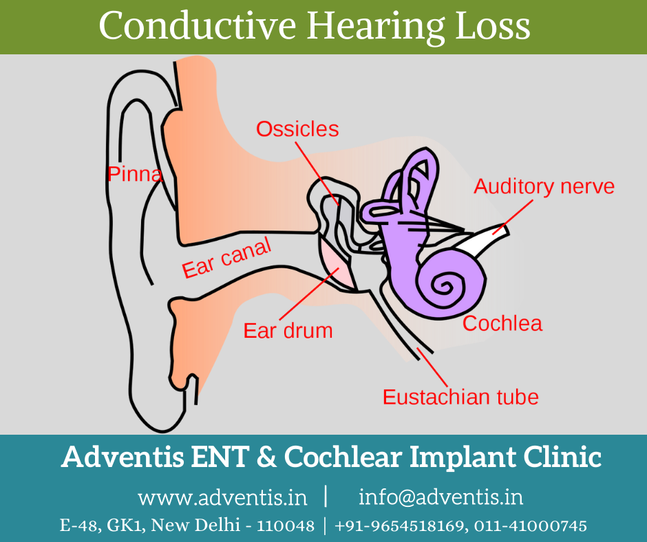 Conductive Hearing Loss Treatment & Surgery in Delhi | Adventis