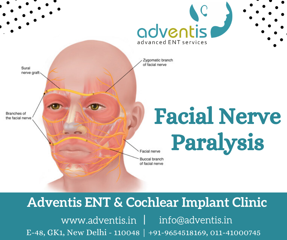 Facial Paralysis