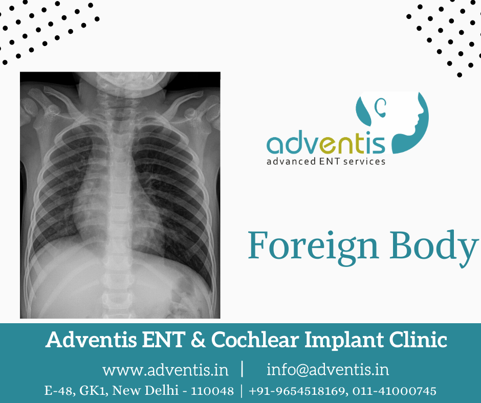 No. 1 Foreign Body Removal ENT Doctor in Delhi | Adventis