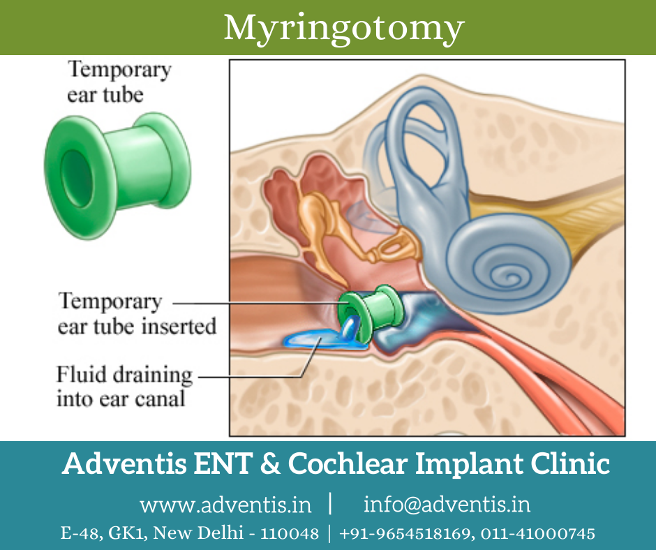 Pediatric Myringotomy & Grommets Ventilation Tubes Surgery in Delhi ...