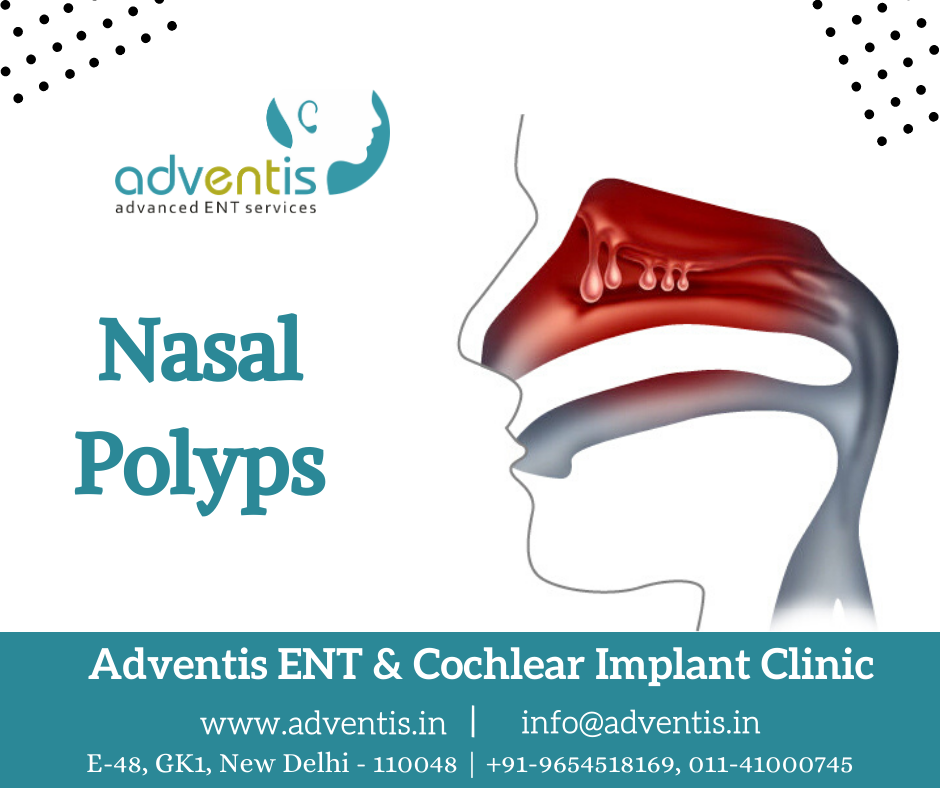 Nasal Polyposis Growing Role Of Biologics In The Nasal Polyposis