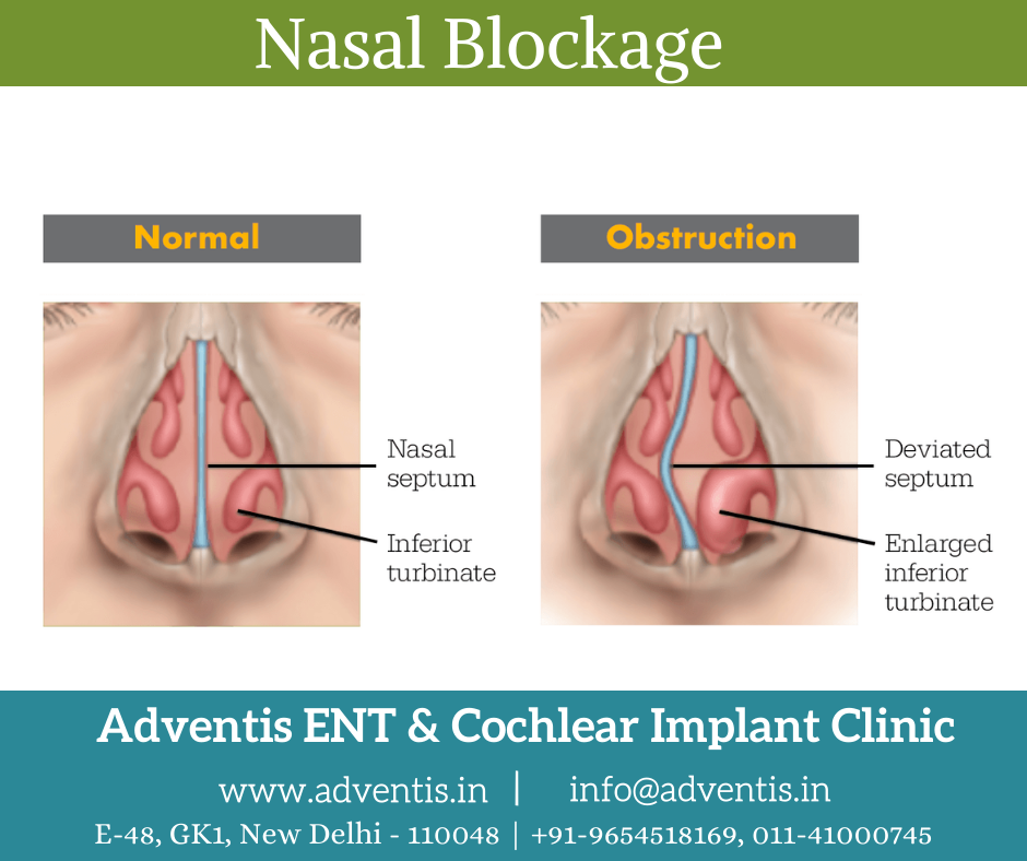 Nasal Blockage Treatment In Delhi Surgery And Cost Adventis Ent