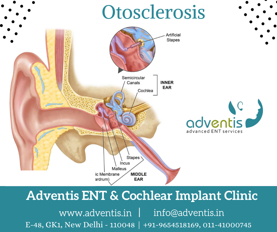 Otosclerosis Diagram Otosclerosis