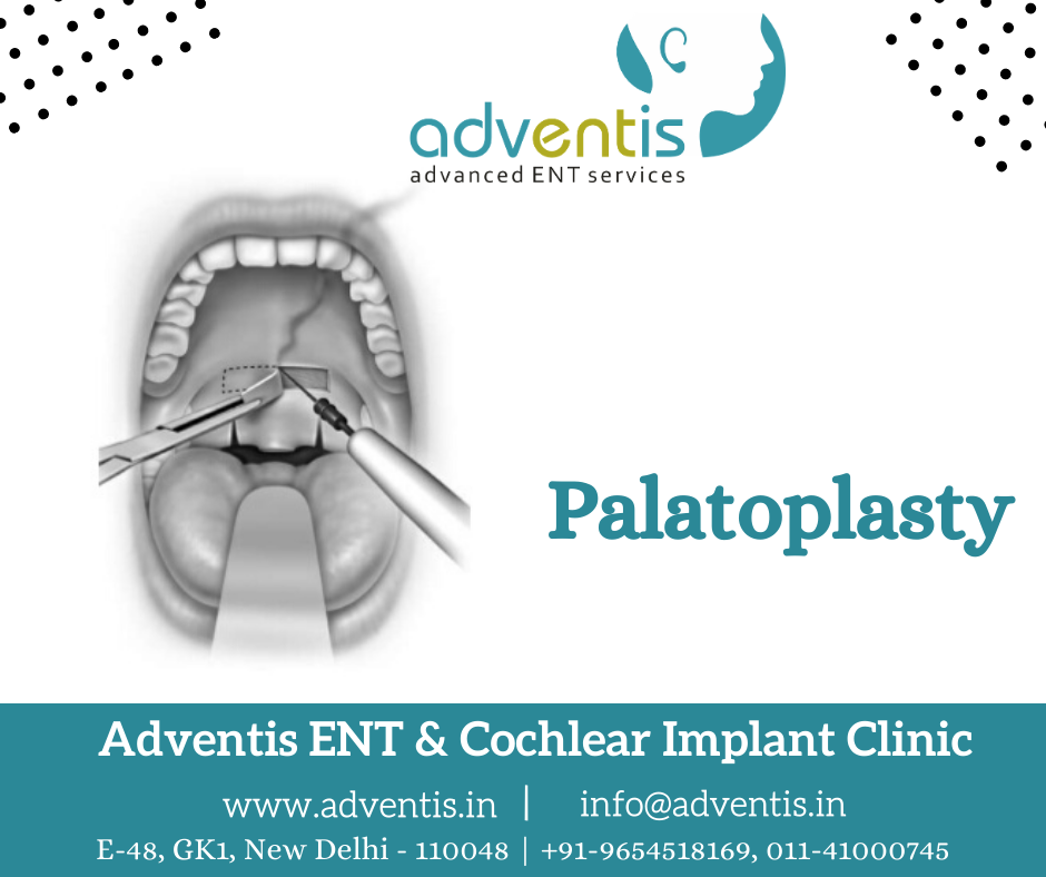 Palatoplasty Surgery in Delhi - Sleep Apnea Palatoplasty | Adventi