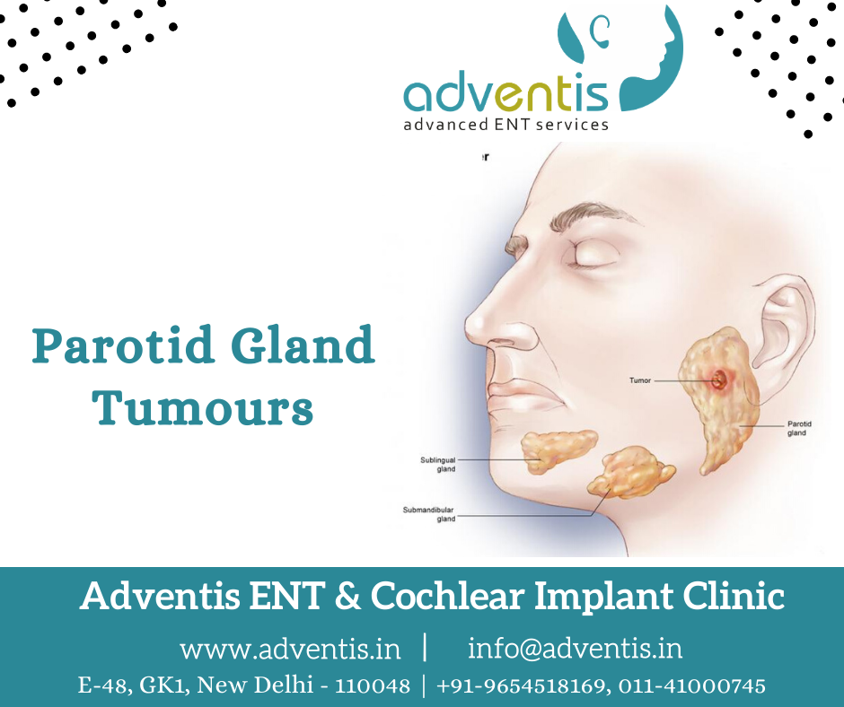 Parotid Gland Swelling