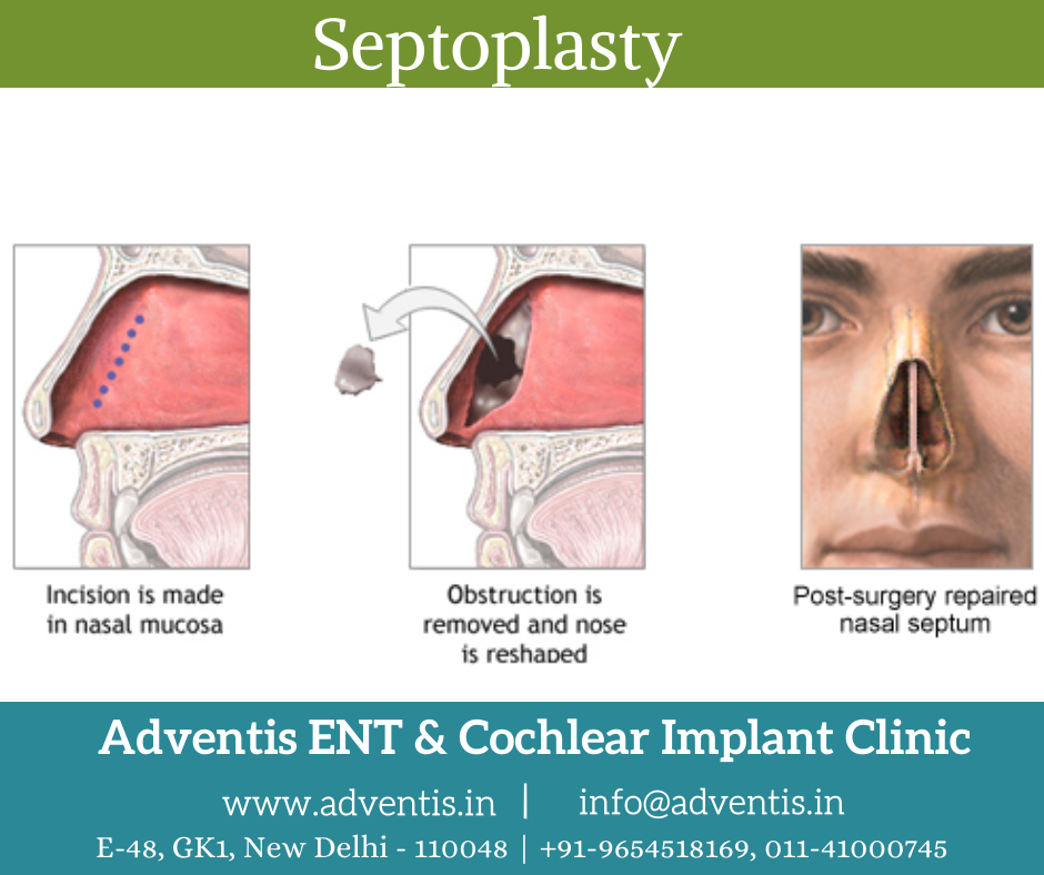 Septoplasty Treatment & Surgery in Delhi | Adventis ENT Head & Neck Clinic